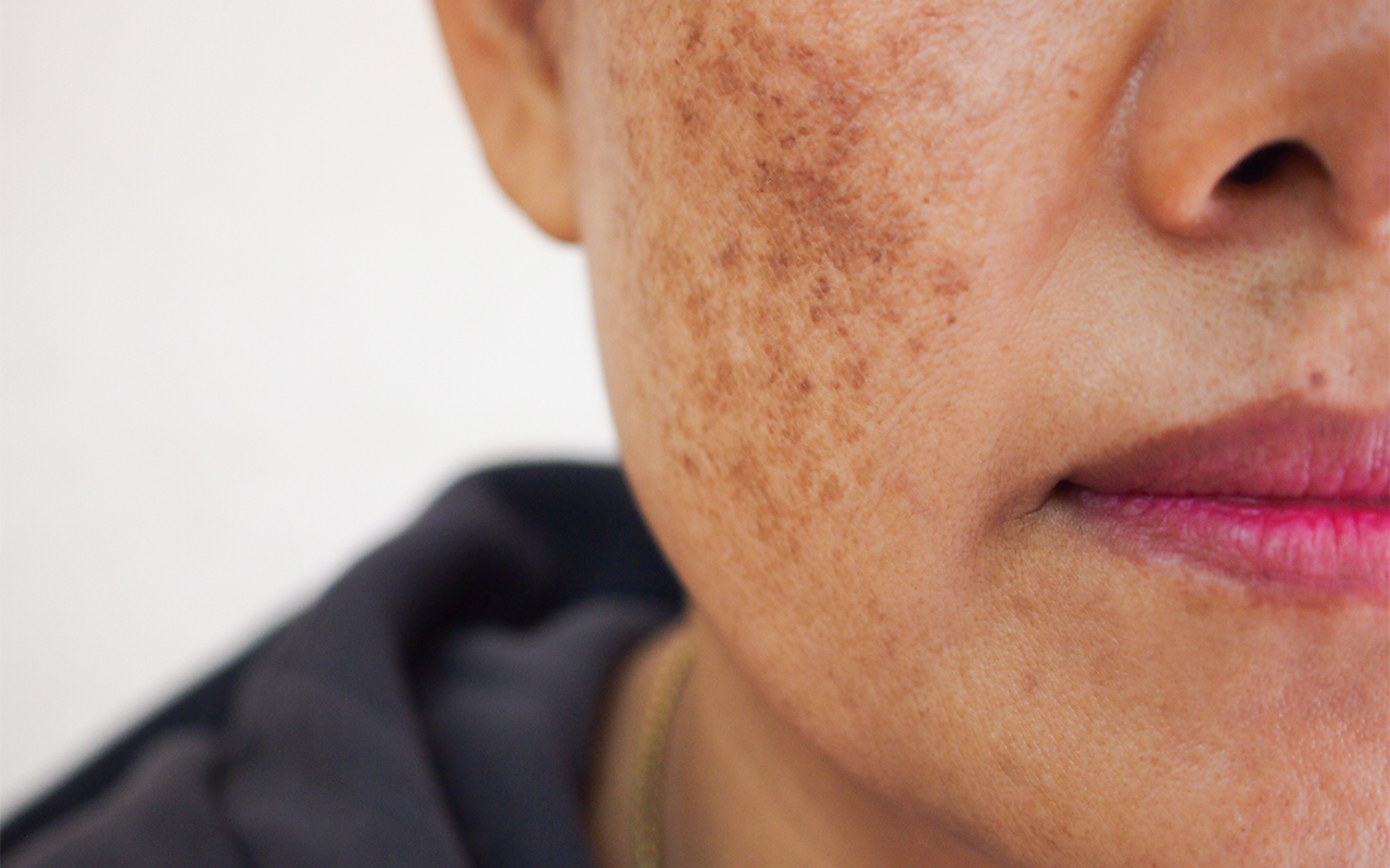 How To Prevent And Repair Sun Damage As Told By A Dermatologist How To Prevent And Repair Sun Damage As Told By A Dermatologist