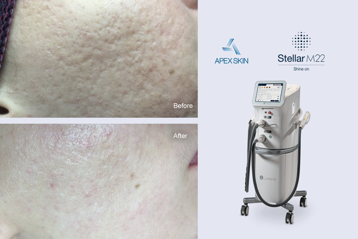 Laser Focus: Introducing the New Lumenis Stellar M22