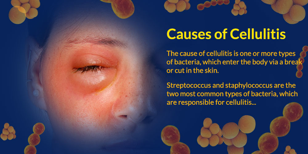 Cellulitis