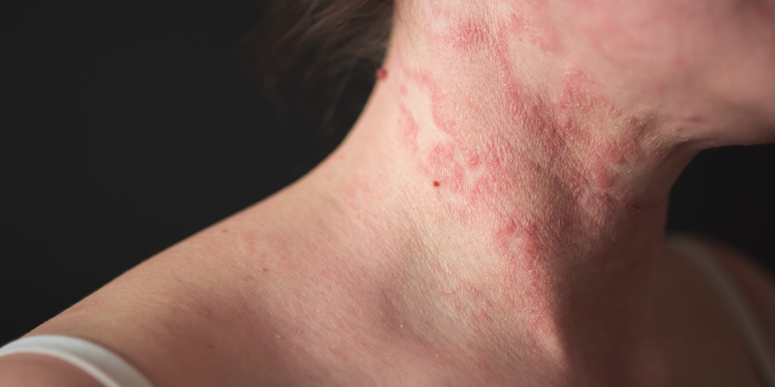 Eczema Treatment (Conditions) - Apex Dermatology & Skin Surgery