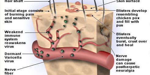 Shingles (Herpes Zoster) - Apex Dermatology & Skin Surgery Center ...