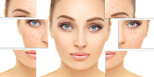 5 Things You Didn’t Know Cause Acne - Apex Dermatology & Skin Surgery