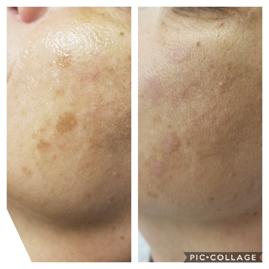 Cryoclear Cryotherapy Treatment - Hyperpigmentation & Skin Tag Removal