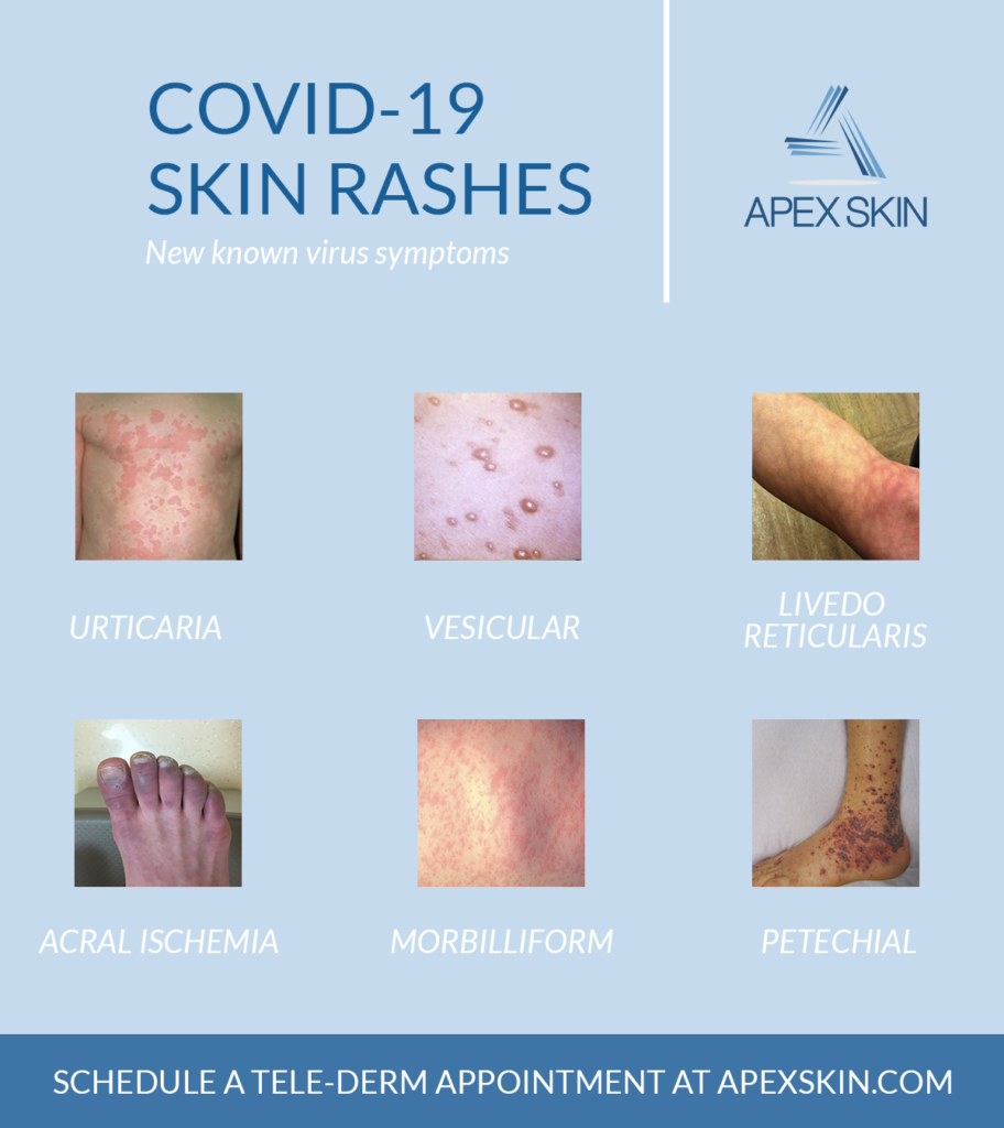 NEW in COVID-19: Skin Rashes Linked to Virus - Apex Skin