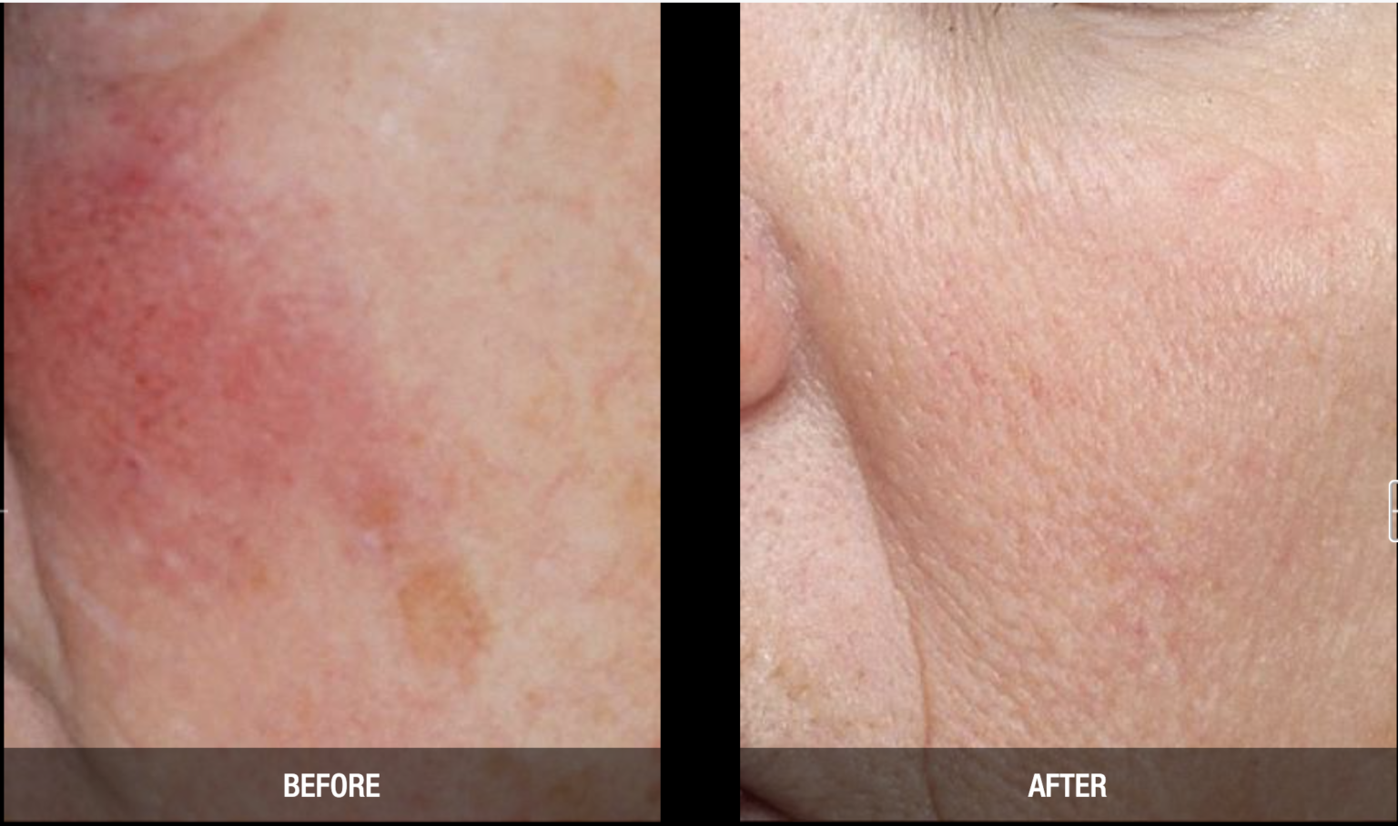 VBeam Laser for Face: Your Ticket to a Rosacea-Free Appearance - Apex Skin