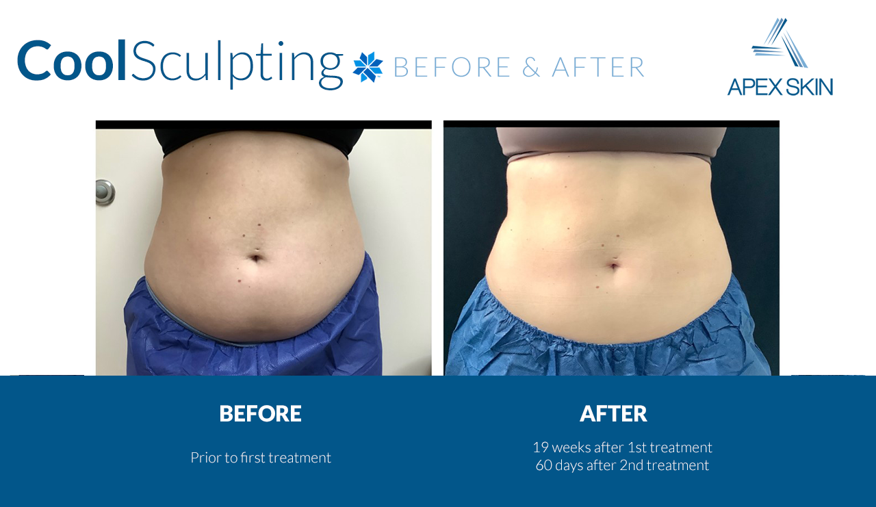 Your CoolSculpting Experience at Apex Skin