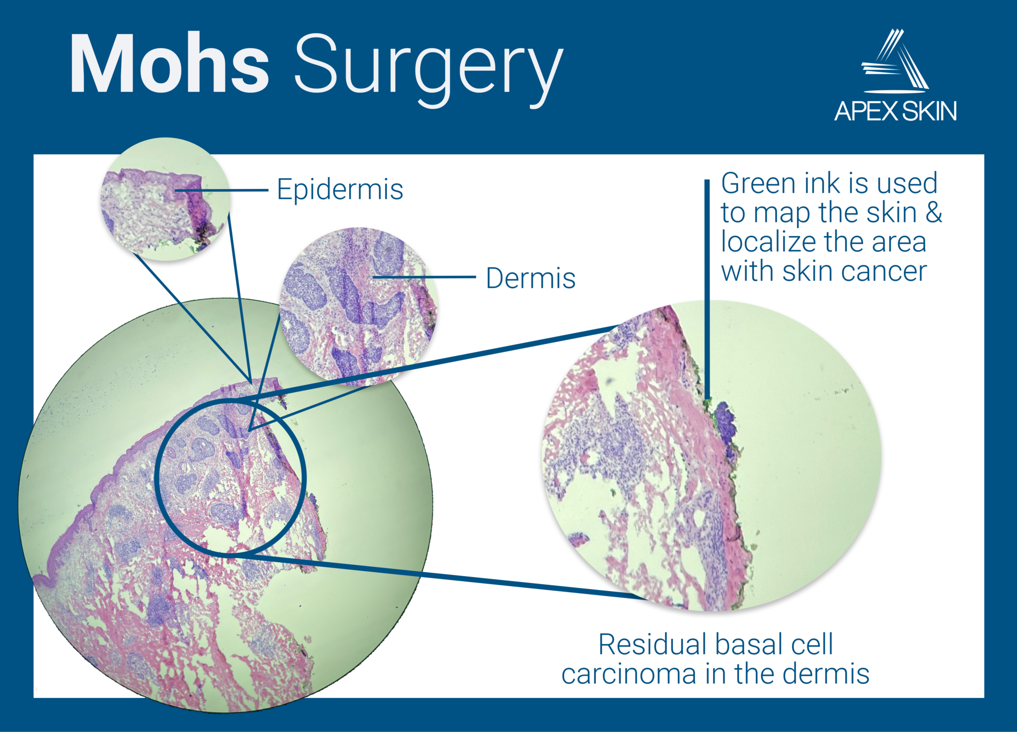 Mohs Surgery: The #1 Method for Removing Skin Cancer, Explained