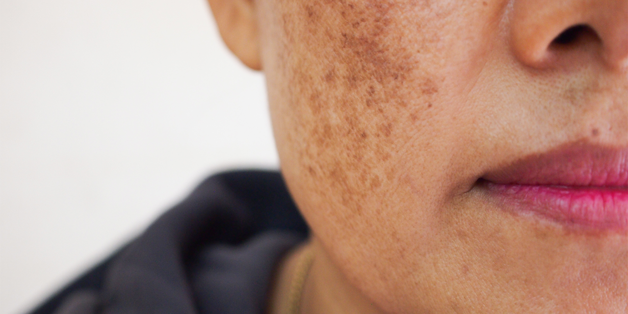 How to Prevent and Repair Sun Damage: As Told by a Dermatologist