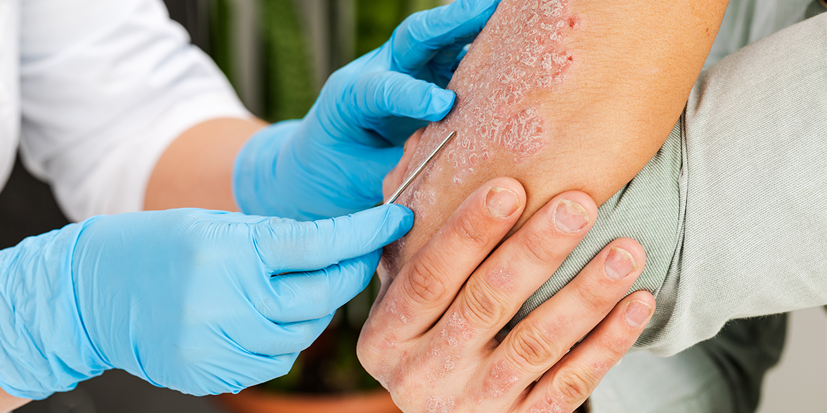A New Approach to Psoriasis Treatment with Clinical Research Forging a ...
