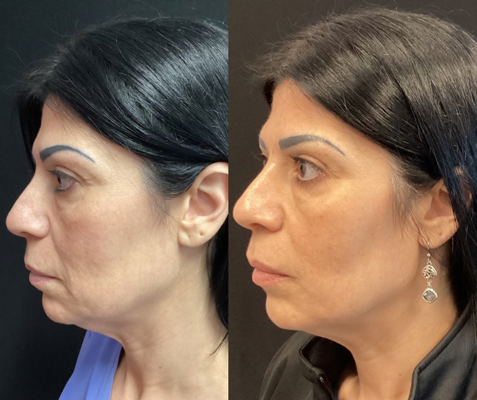 Emface Facial Contouring Needleless Skin Tightening Treatments