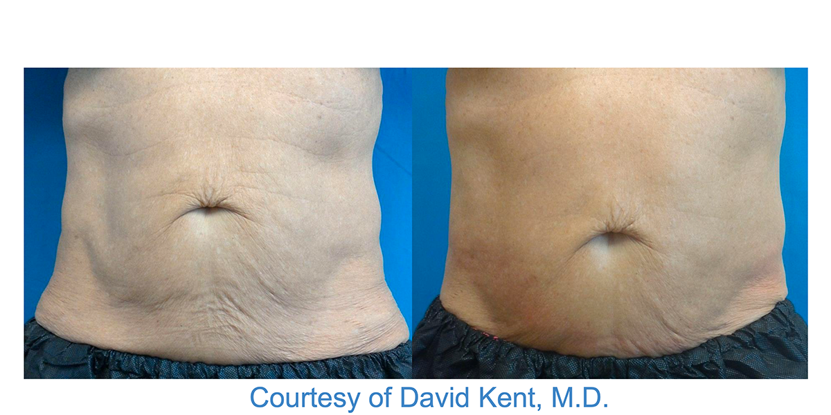 Exion Treatment - Exion Before and After Results & Reviews