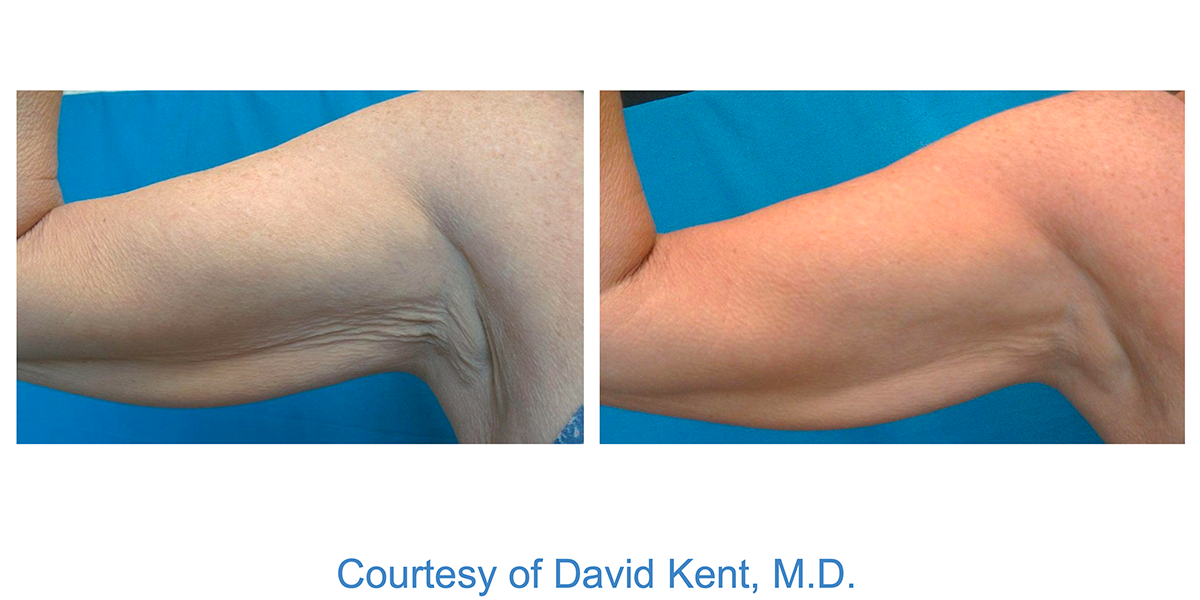 Exion Treatment - Exion Before and After Results & Reviews