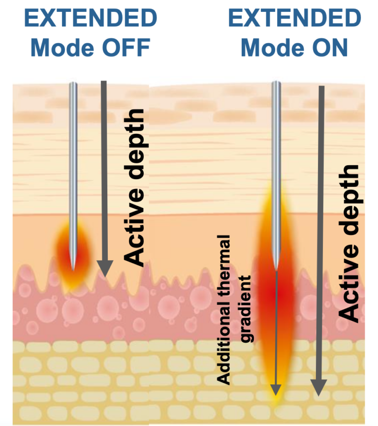 Exion Treatment - Exion Before and After Results & Reviews